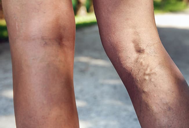 A Visual Guide to Vein and Artery Problems – Stay Healthy Weekly Magazine