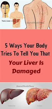 5 Ways the Body Tries To Tell That Your Liver is Overworked – Stay ...