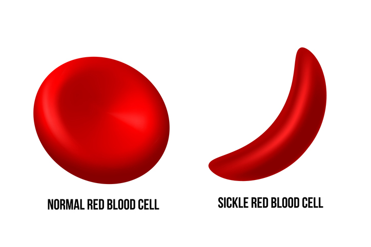 Breaking down sickle cell disease: Symptoms, triggers, and treatments ...